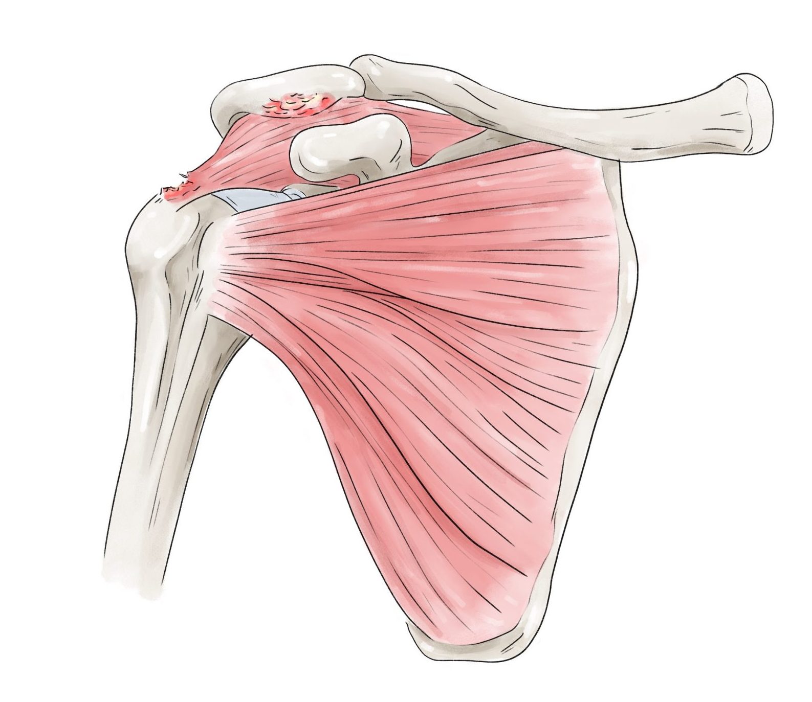 Acromioplastie - Chirurgie de l'épaule Bordeaux-Mérignac