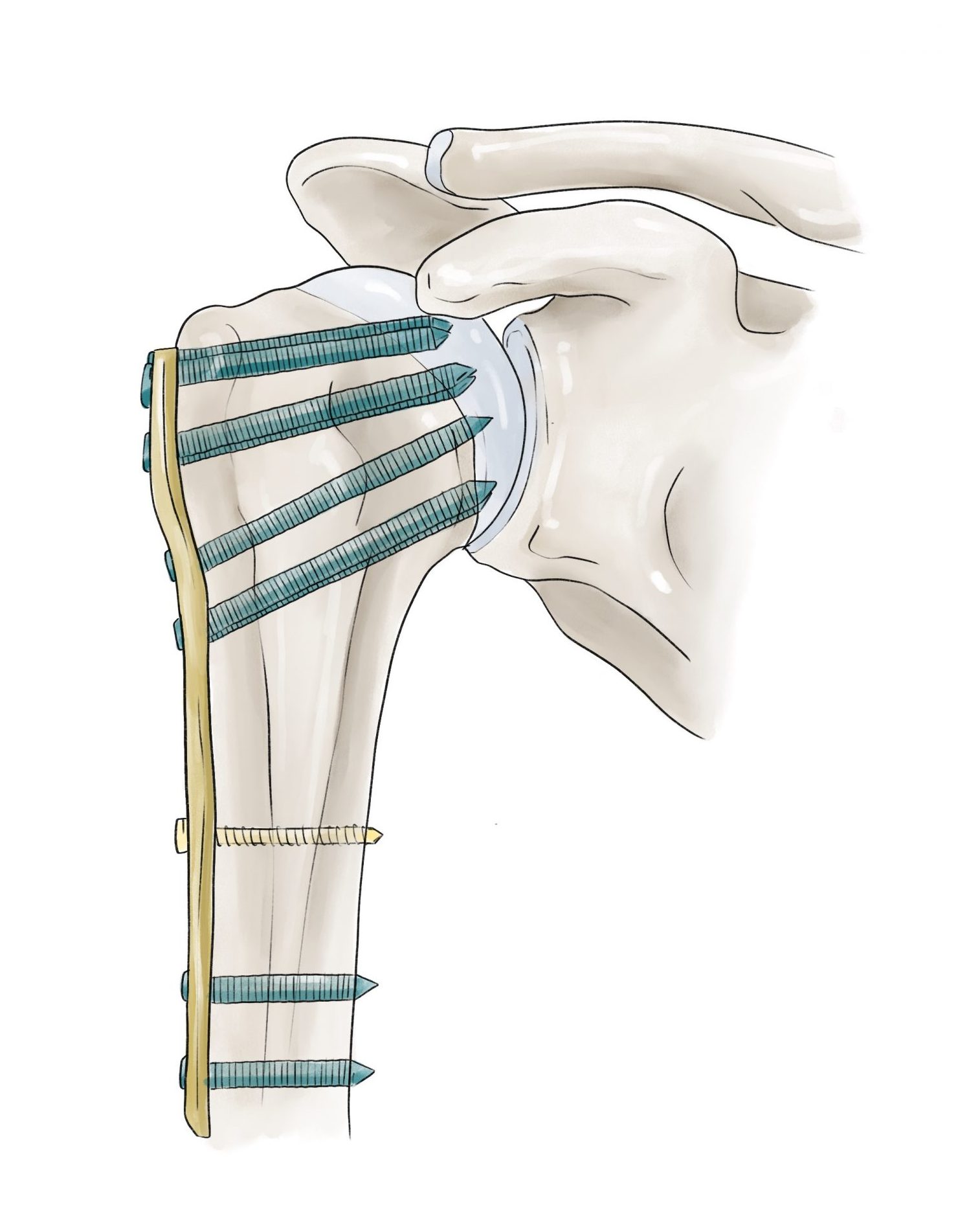 Fracture de l'humérus proximal - Chirurgie de l'épaule Bordeaux-Mérignac